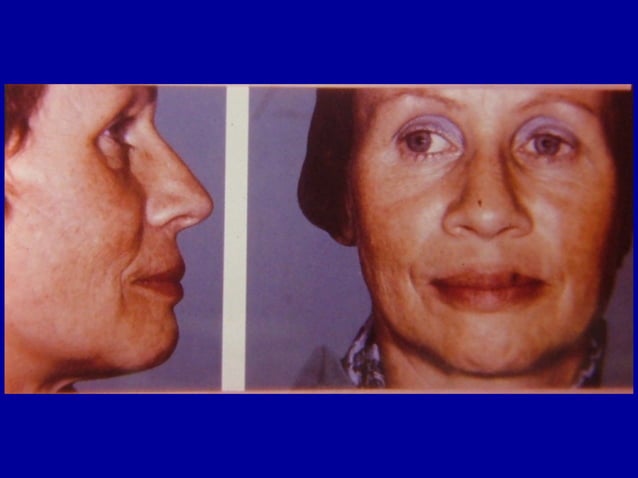 11.complete denture wax‐up and flasking procedure | PPT