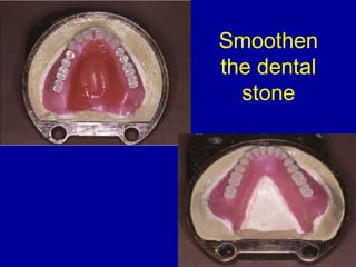 11.complete denture wax‐up and flasking procedure | PPT