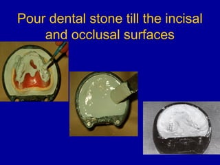 11.complete denture wax‐up and flasking procedure | PPT