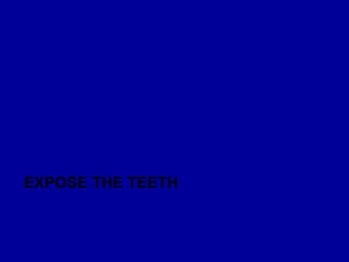 11.complete denture wax‐up and flasking procedure | PPT