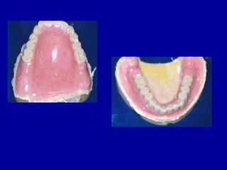 11.complete denture wax‐up and flasking procedure | PPT