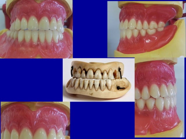 11.complete denture wax‐up and flasking procedure | PPT