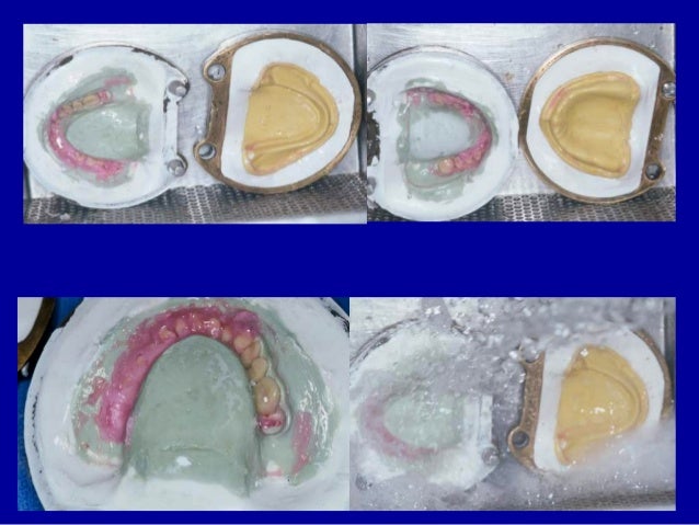 11.complete denture wax‐up and flasking procedure
