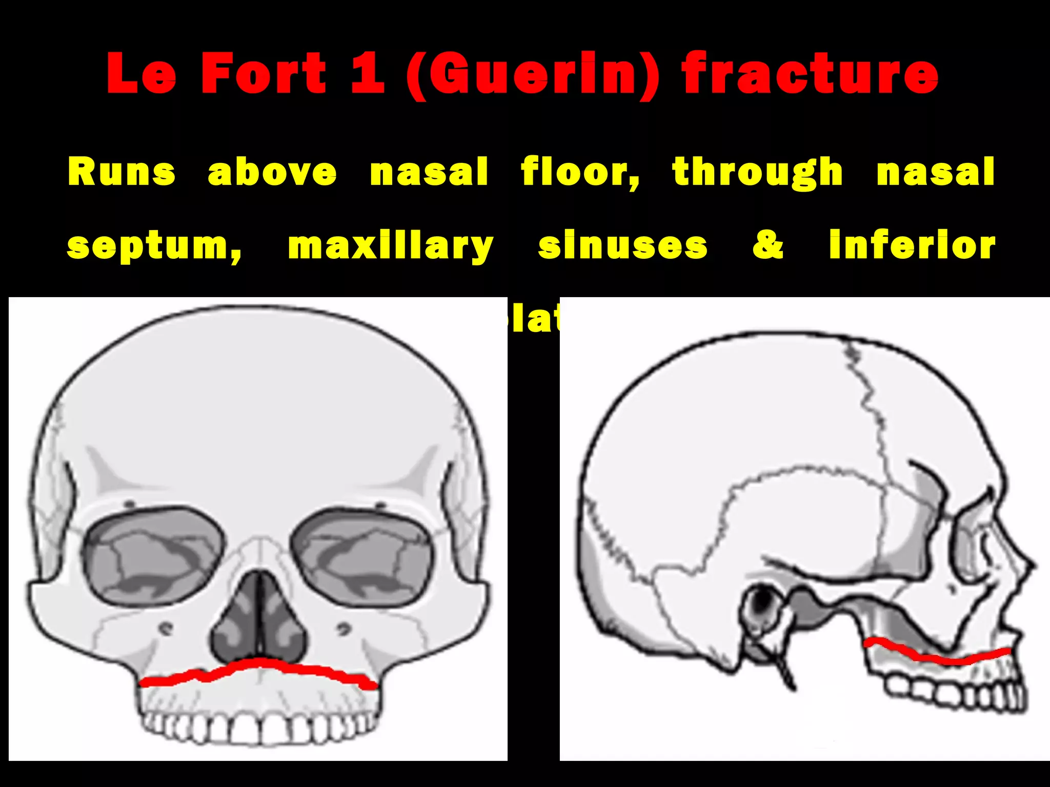 Facial bone fractures | PPT