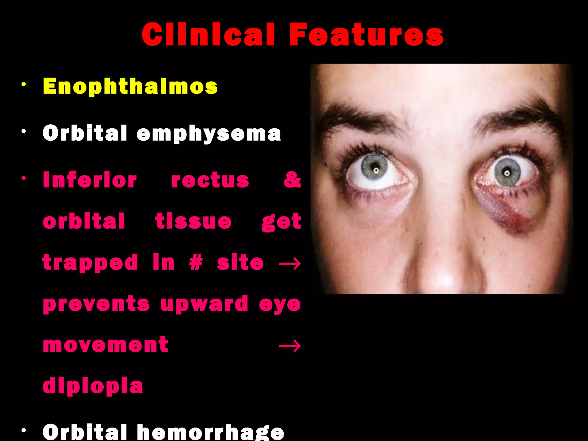 Facial bone fractures | PPT