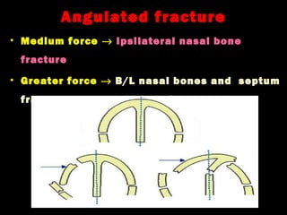 Facial bone fractures | PPT