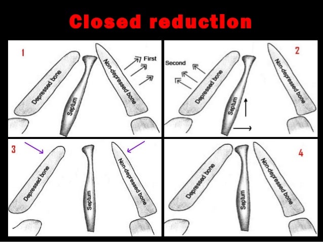 11. facial bone fractures