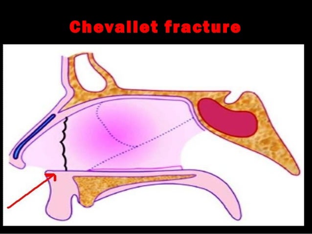 11. facial bone fractures