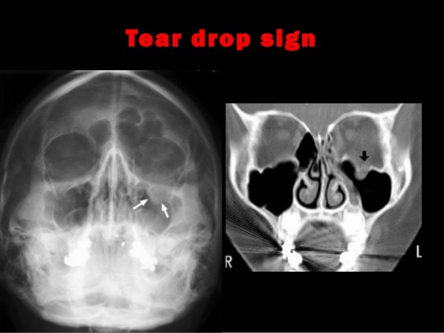 11. facial bone fractures