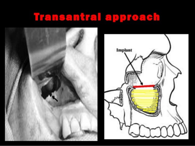 11. facial bone fractures