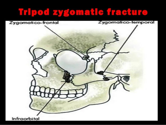 11. facial bone fractures