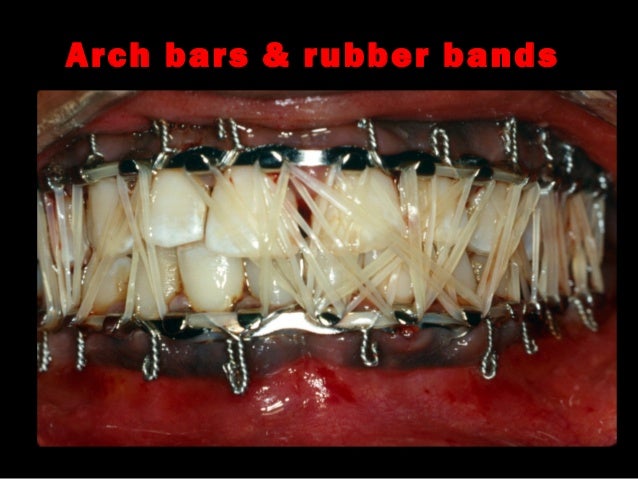 11. facial bone fractures