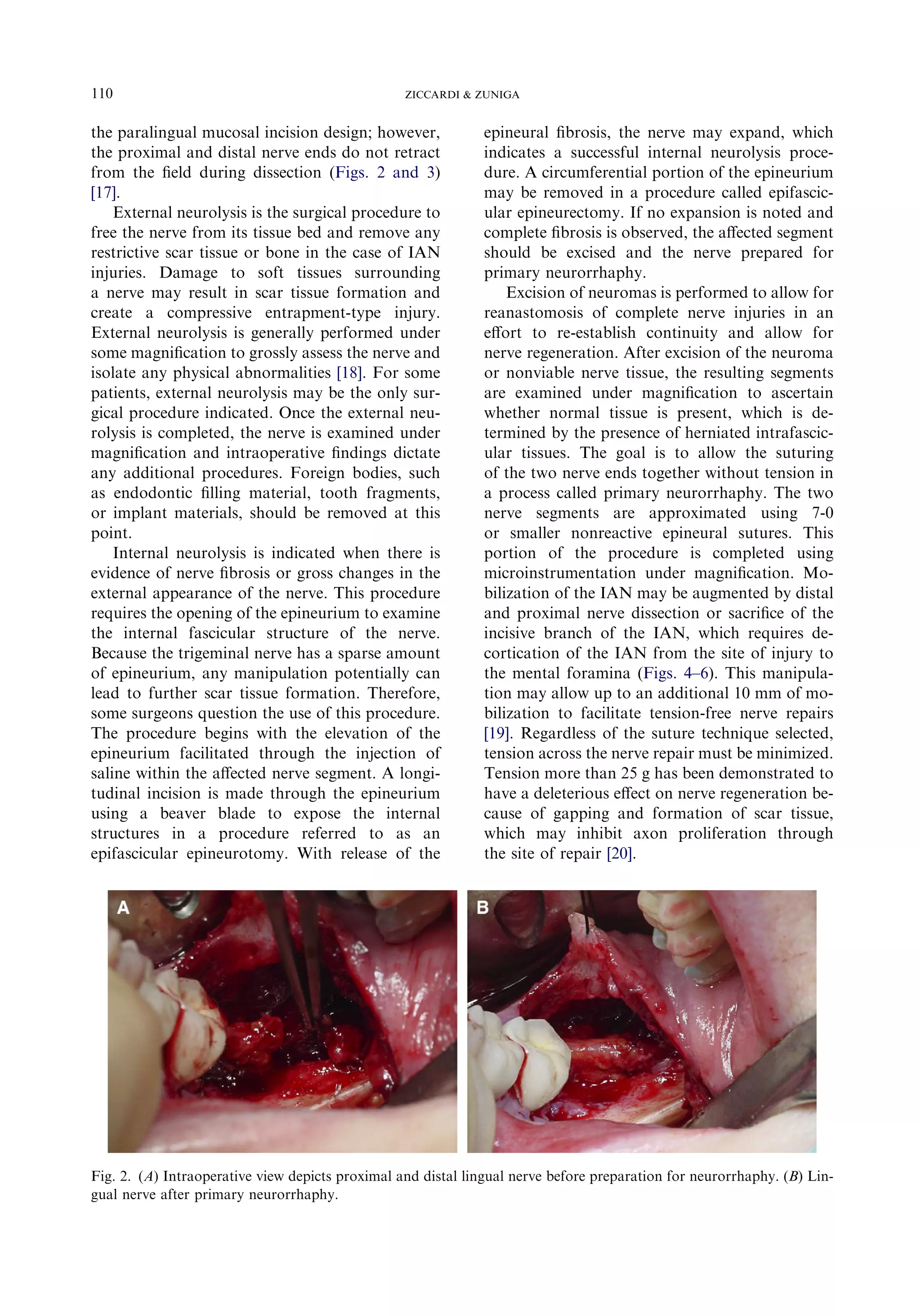 Nerve Injuries After Third Molar Removal | PDF
