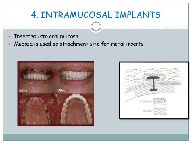Basic aspects of implants
