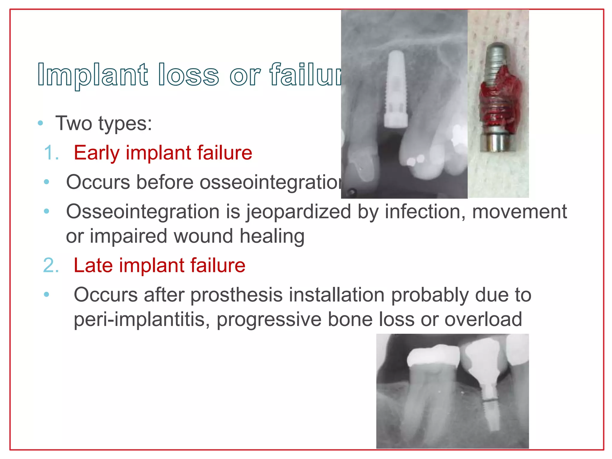 Implant related complications and failure | PPSX