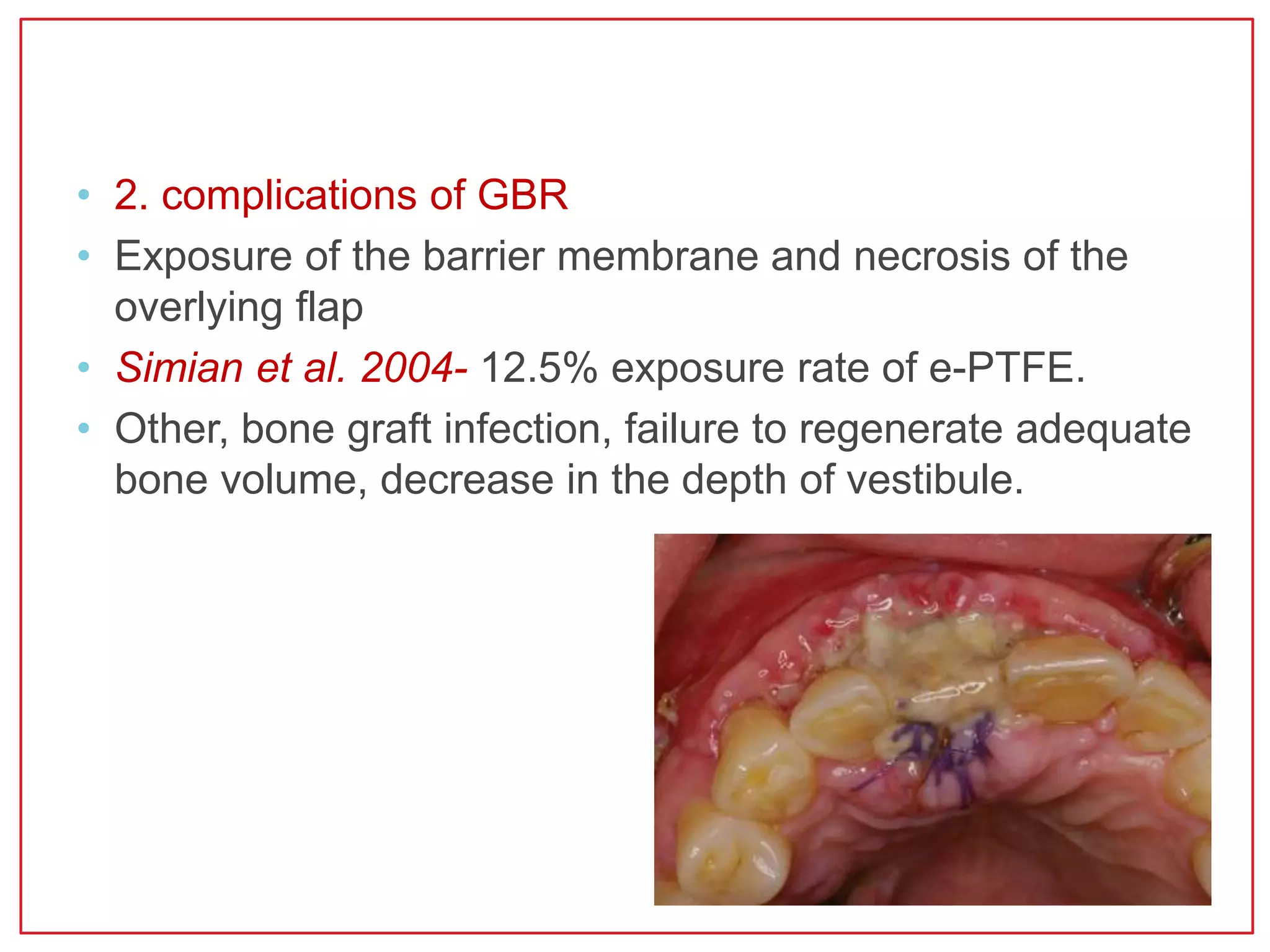 Implant related complications and failure | PPSX