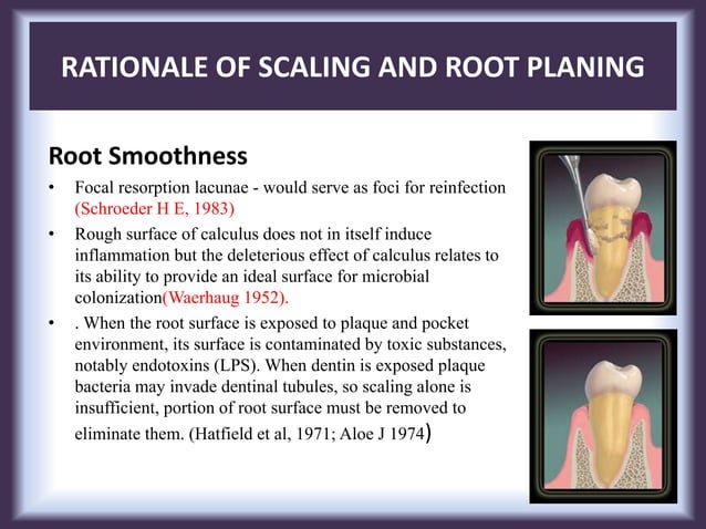 11.scaling and root planing | PPTX | Dental Health | Diseases and ...