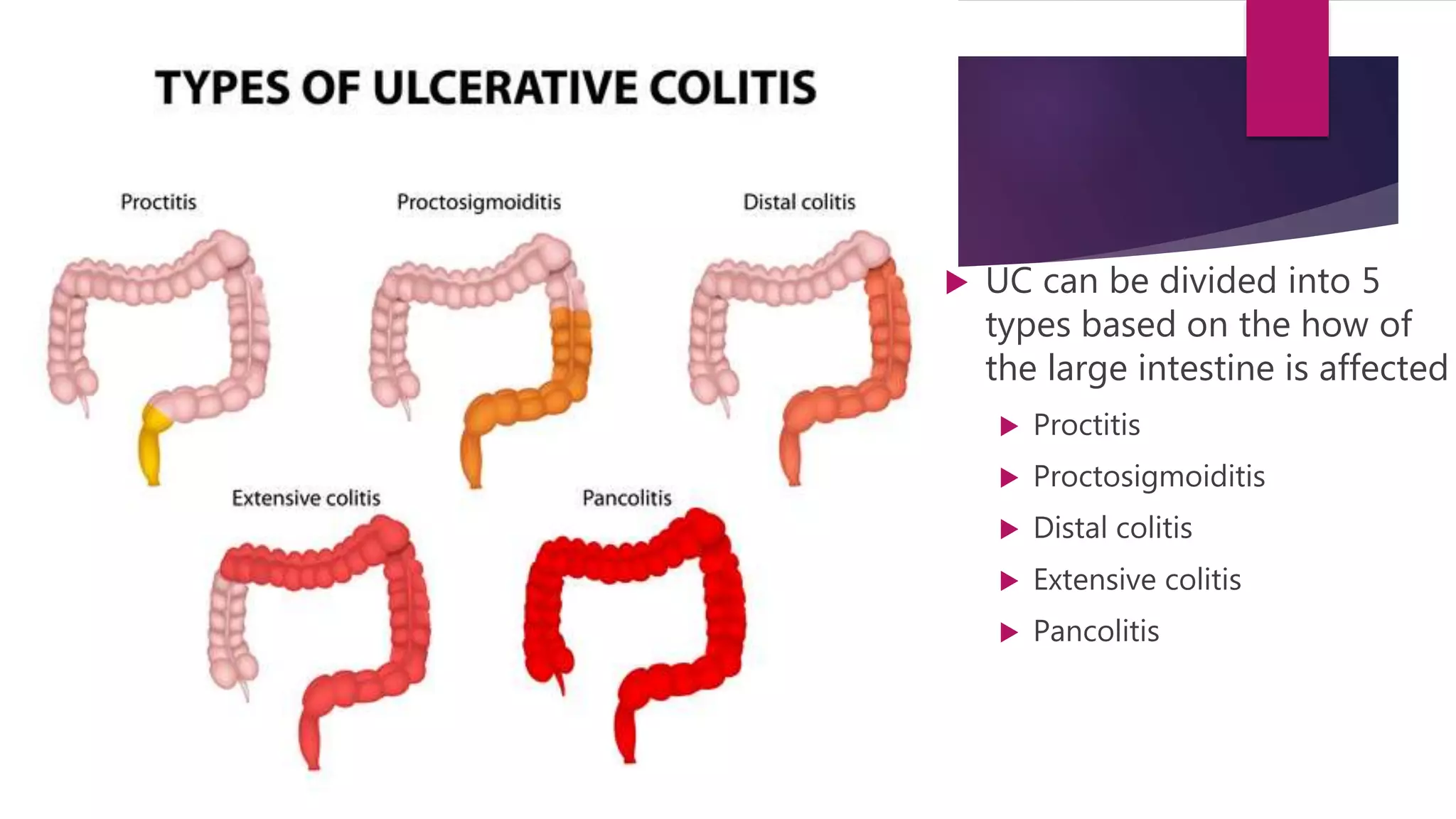 Ulcerative Colitis (IBD) | PPTX