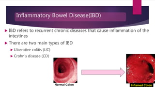 Ulcerative Colitis (IBD) | PPTX