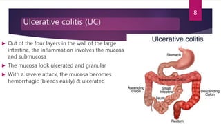 Ulcerative Colitis (IBD) | PPTX