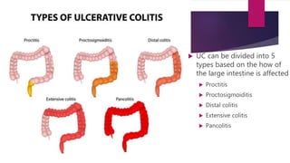 Ulcerative Colitis (IBD) | PPTX