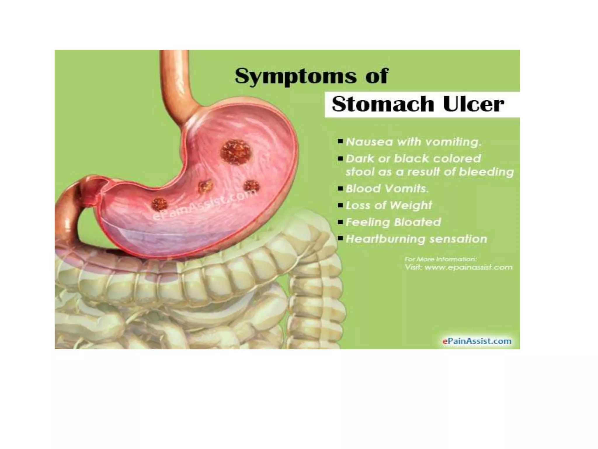 pharmacology of peptic ulcer disease | PPTX