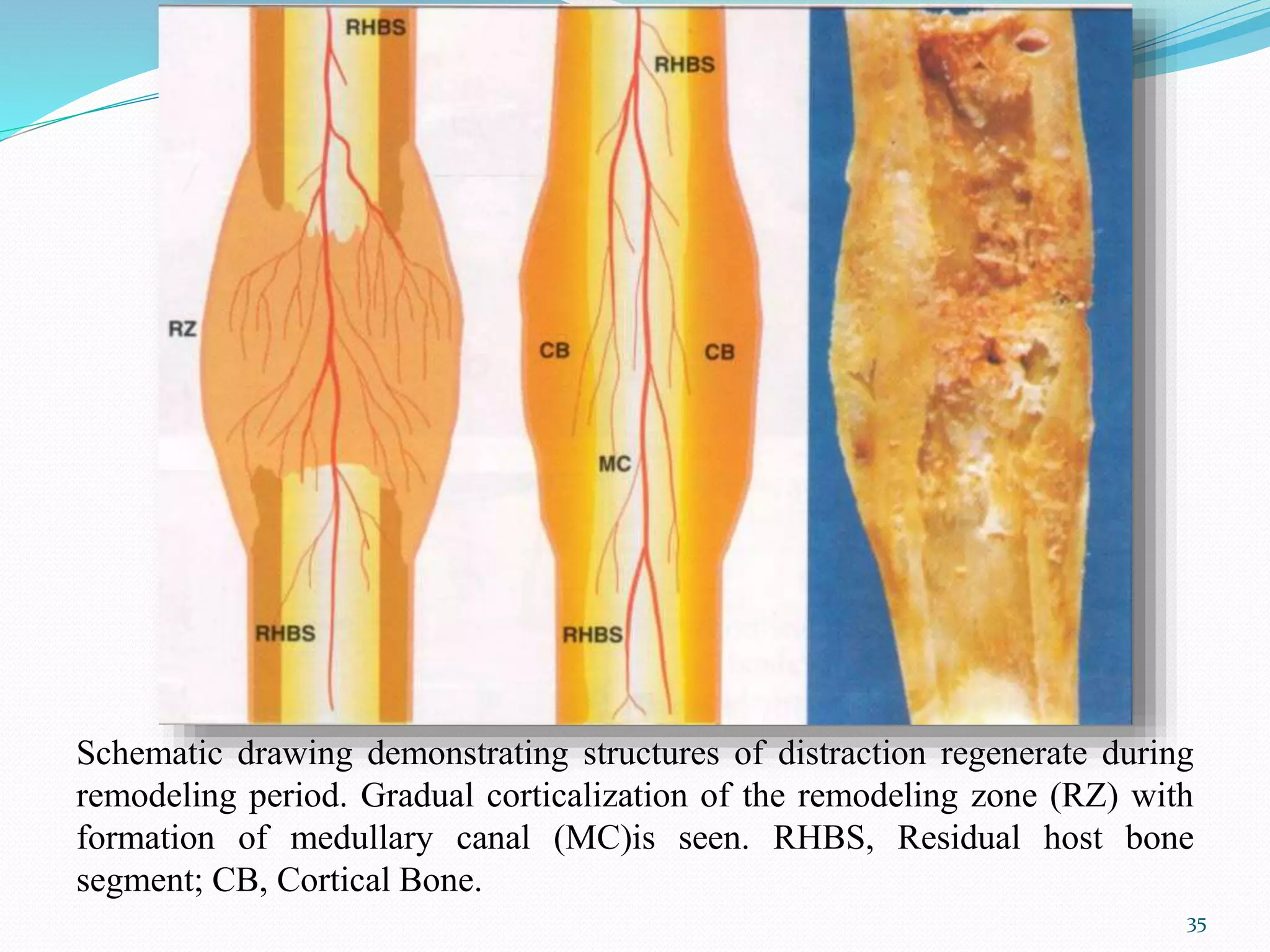distraction osteogenesis | PPTX