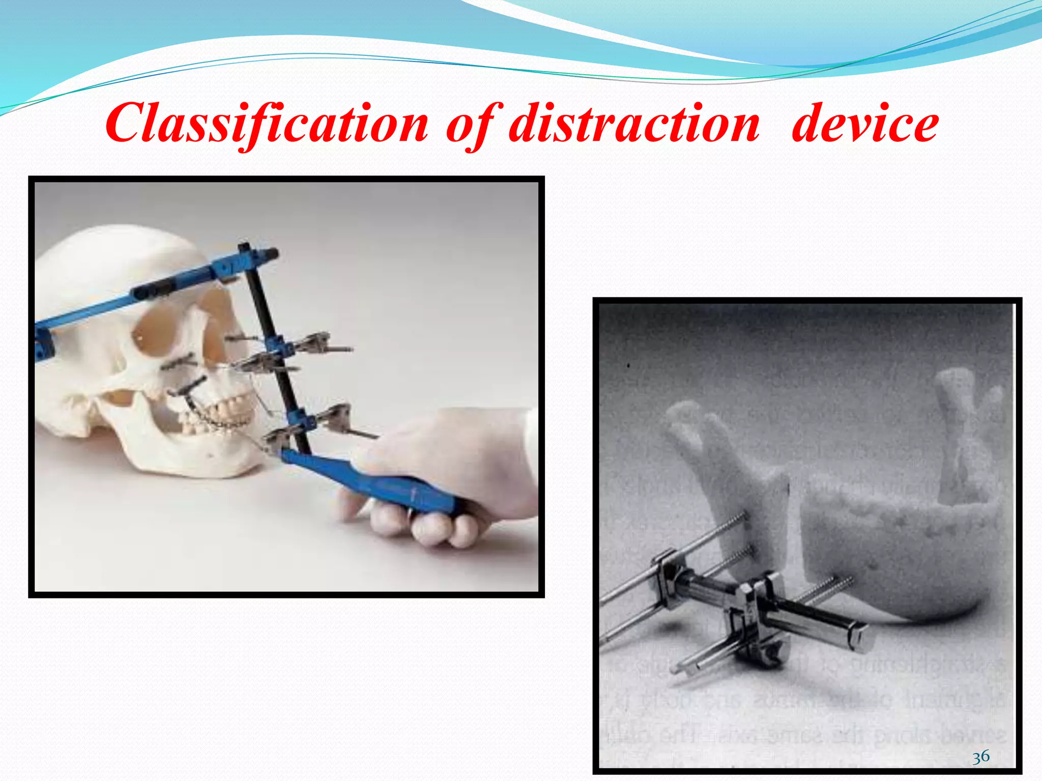 distraction osteogenesis | PPTX