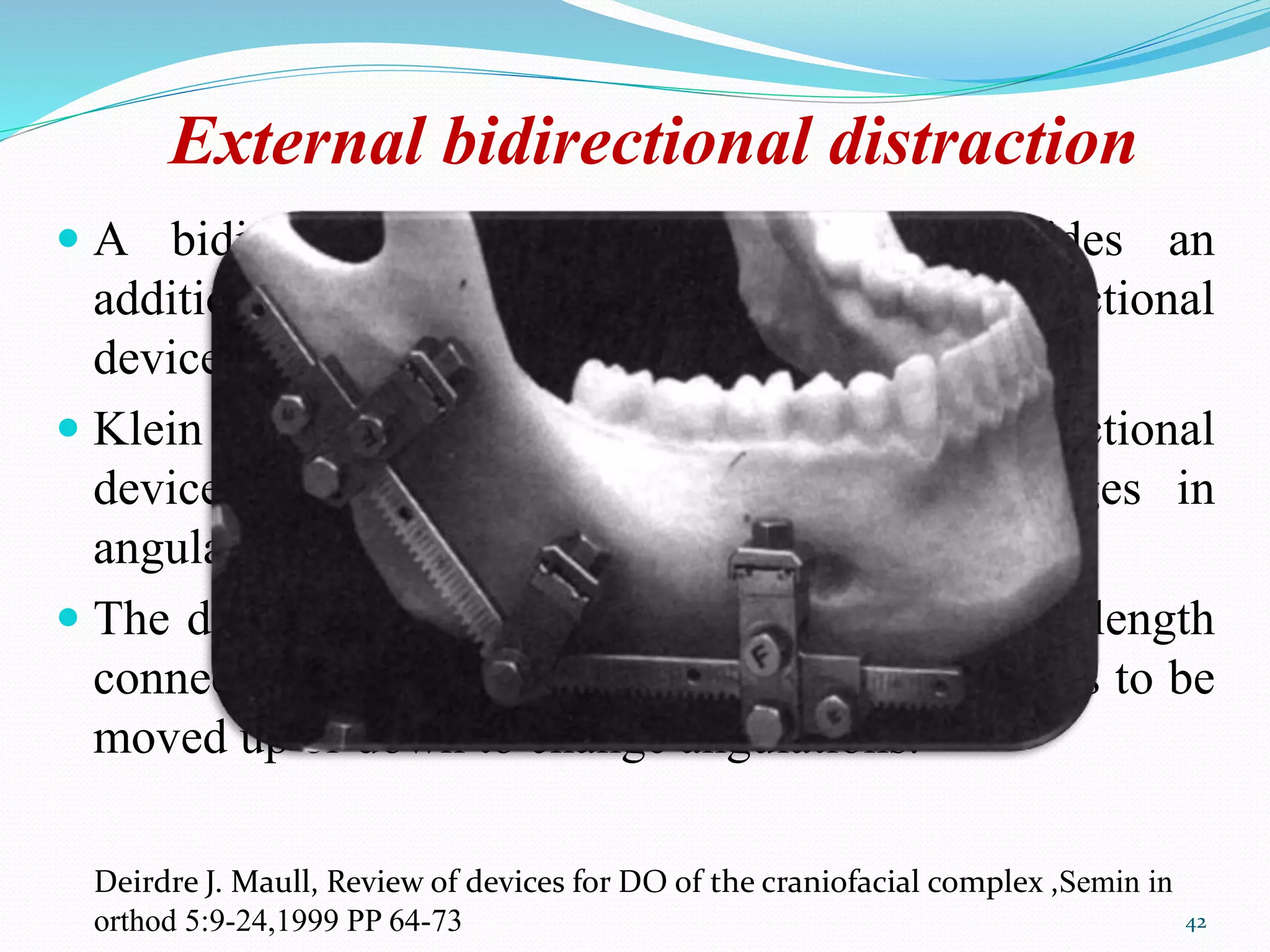 distraction osteogenesis | PPTX