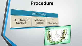 DENTAL CARIES - INDICES | PPTX