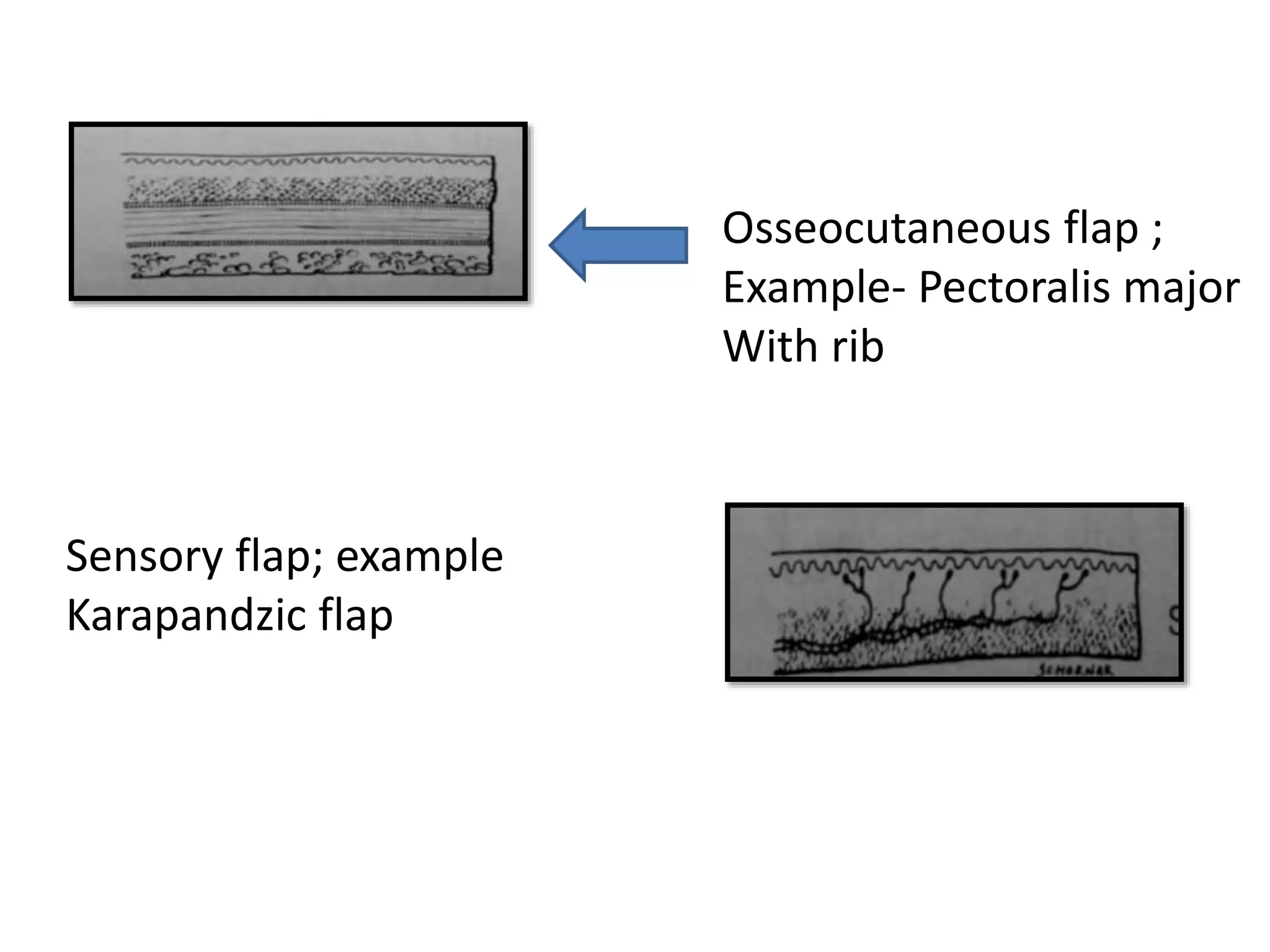 local reconstruction flaps in maxillofacial surgery | PPTX