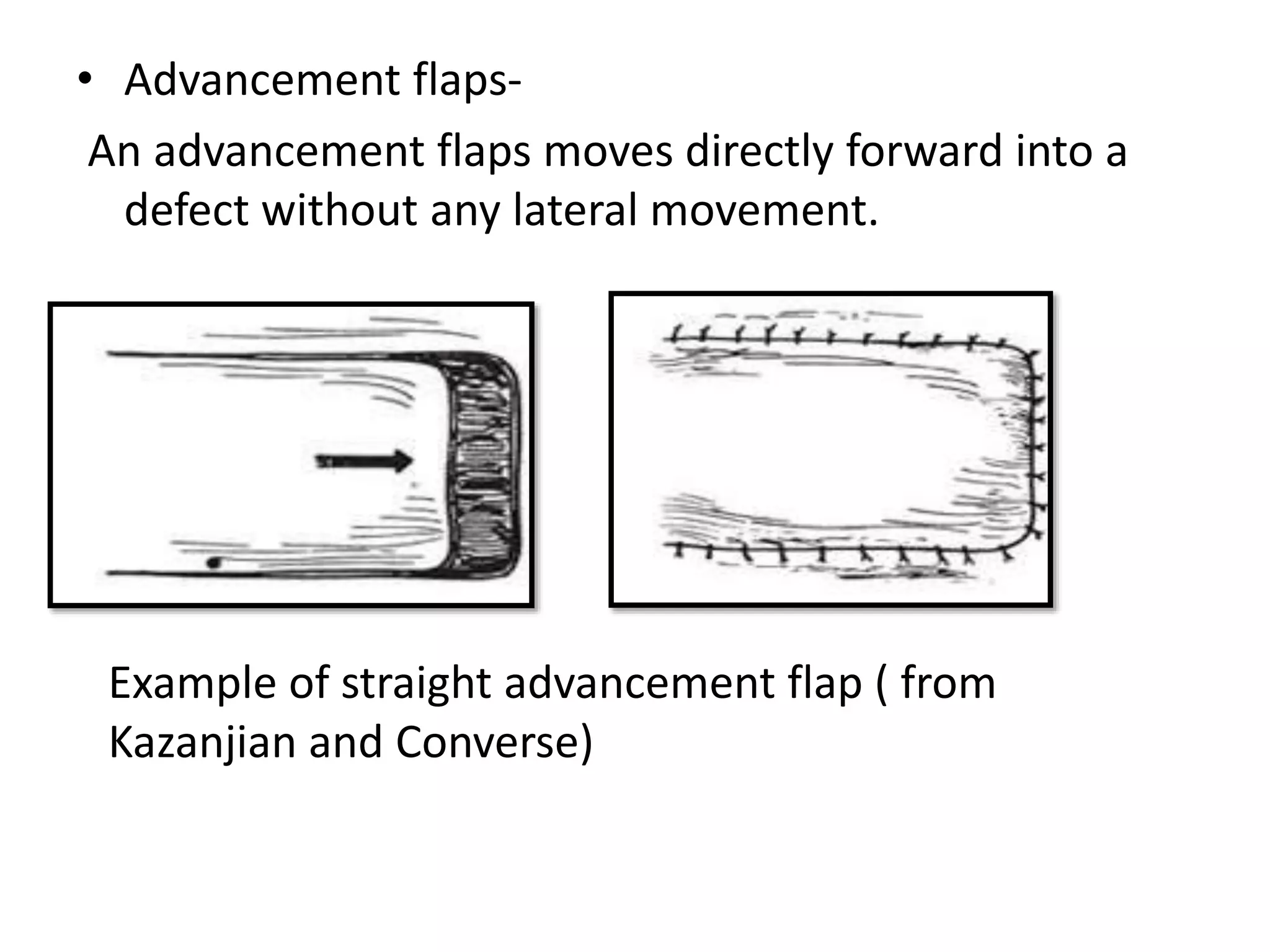 local reconstruction flaps in maxillofacial surgery | PPTX