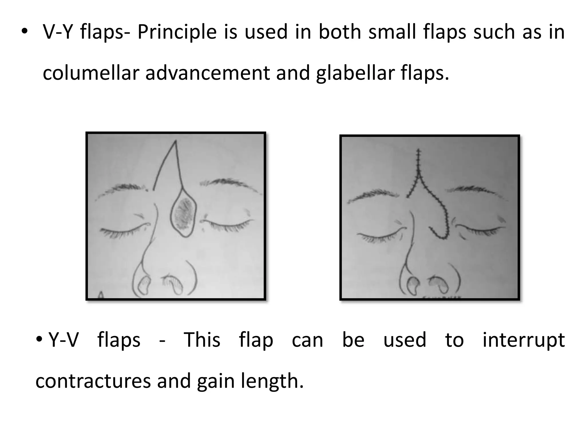 local reconstruction flaps in maxillofacial surgery | PPTX