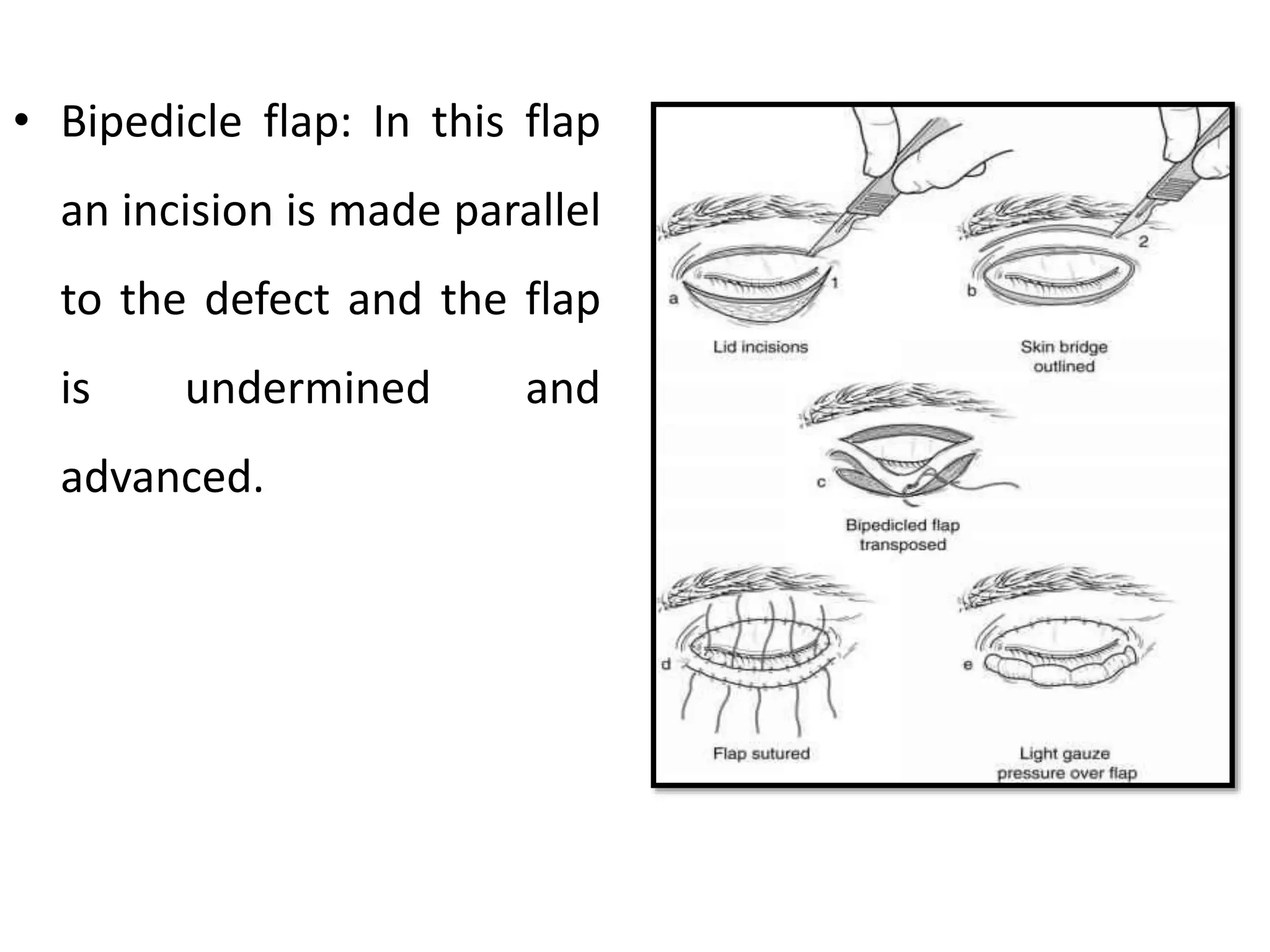 local reconstruction flaps in maxillofacial surgery | PPTX