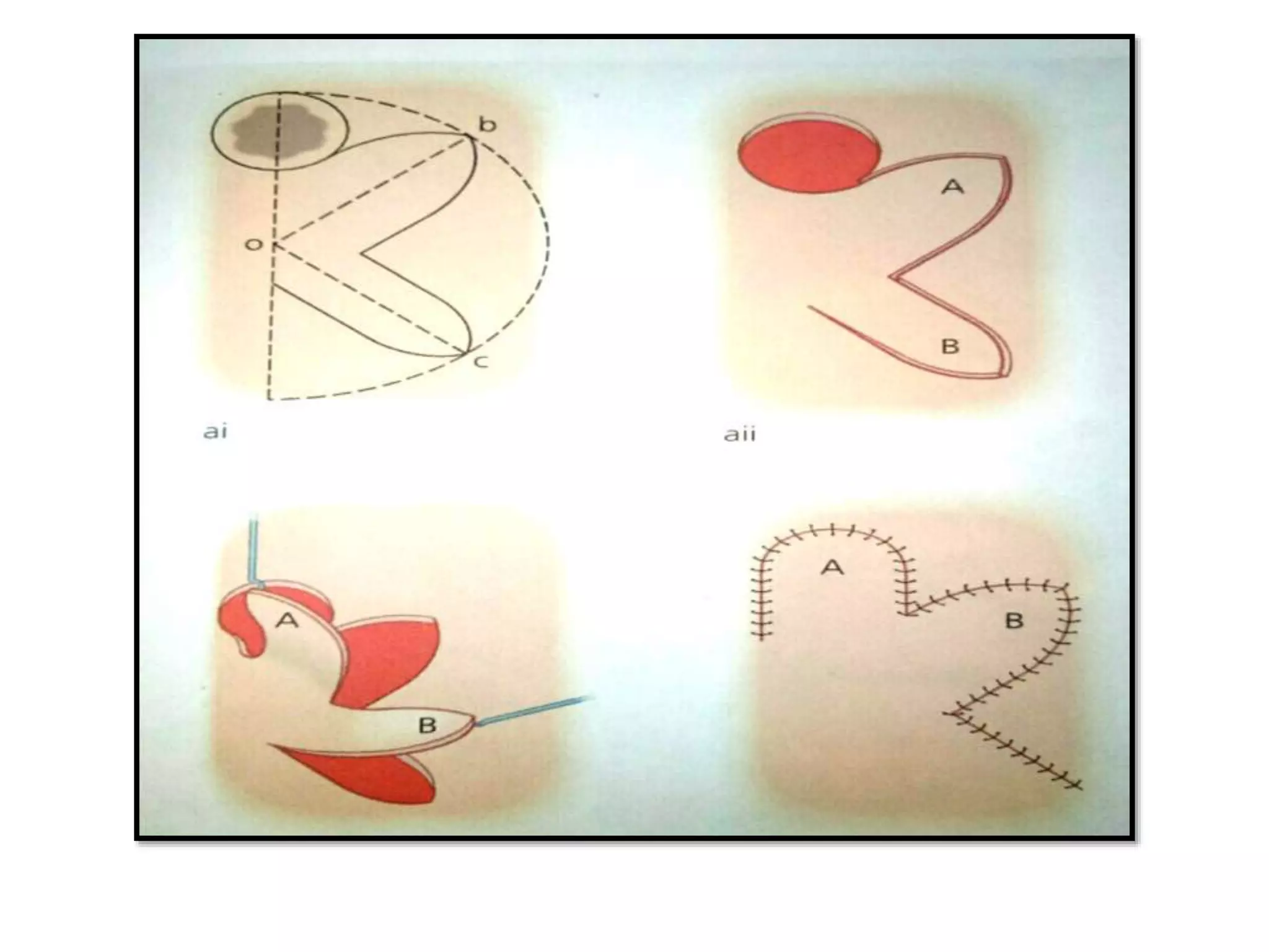local reconstruction flaps in maxillofacial surgery | PPTX