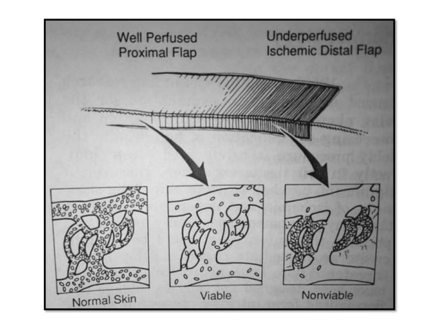 local reconstruction flaps in maxillofacial surgery | PPTX | First Aid ...