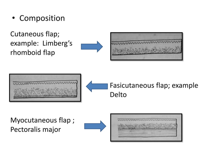 local reconstruction flaps in maxillofacial surgery | PPTX | First Aid ...