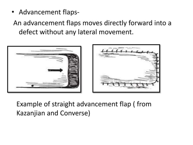 local reconstruction flaps in maxillofacial surgery | PPTX | First Aid ...