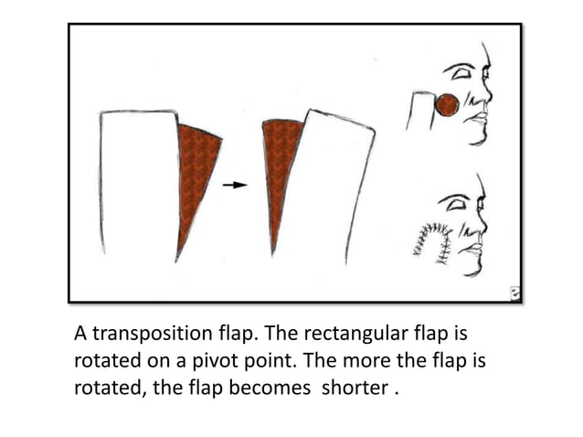 local reconstruction flaps in maxillofacial surgery | PPTX | First Aid ...