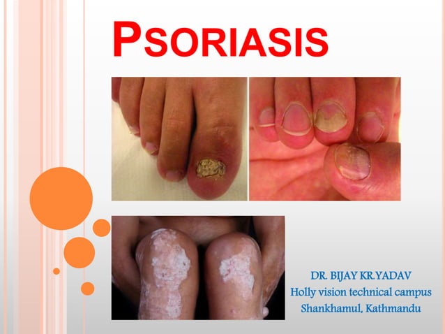 11. Psoriasis | PPTX | Skin and Dermatology | Diseases and Conditions