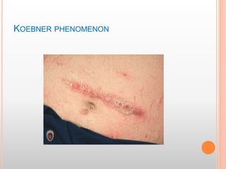 11. Psoriasis | PPTX | Skin and Dermatology | Diseases and Conditions