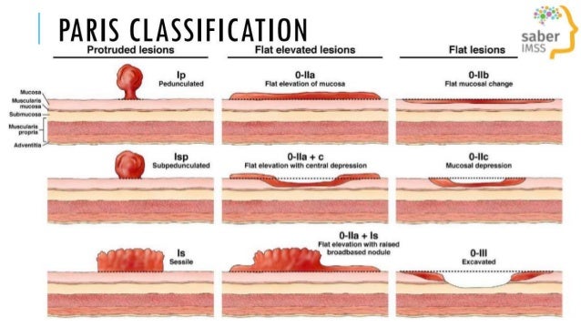Patrones en polipos de colon