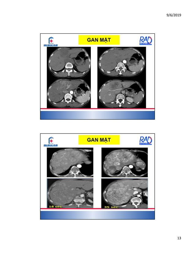 Yeu to ky thuat anh huong chat luong chan doan trong chup CT bung co ...