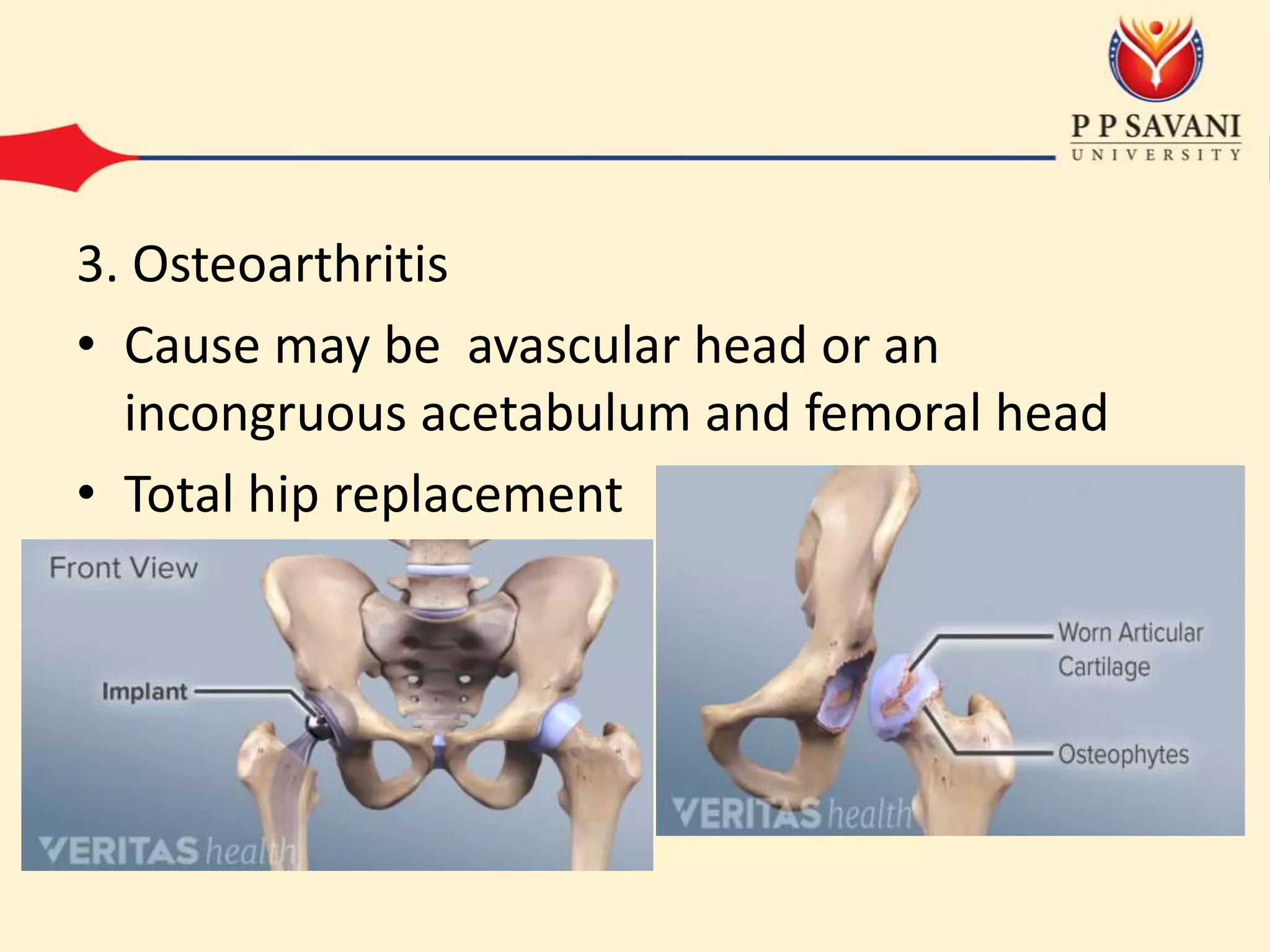 11. Hip dislocation | PPTX