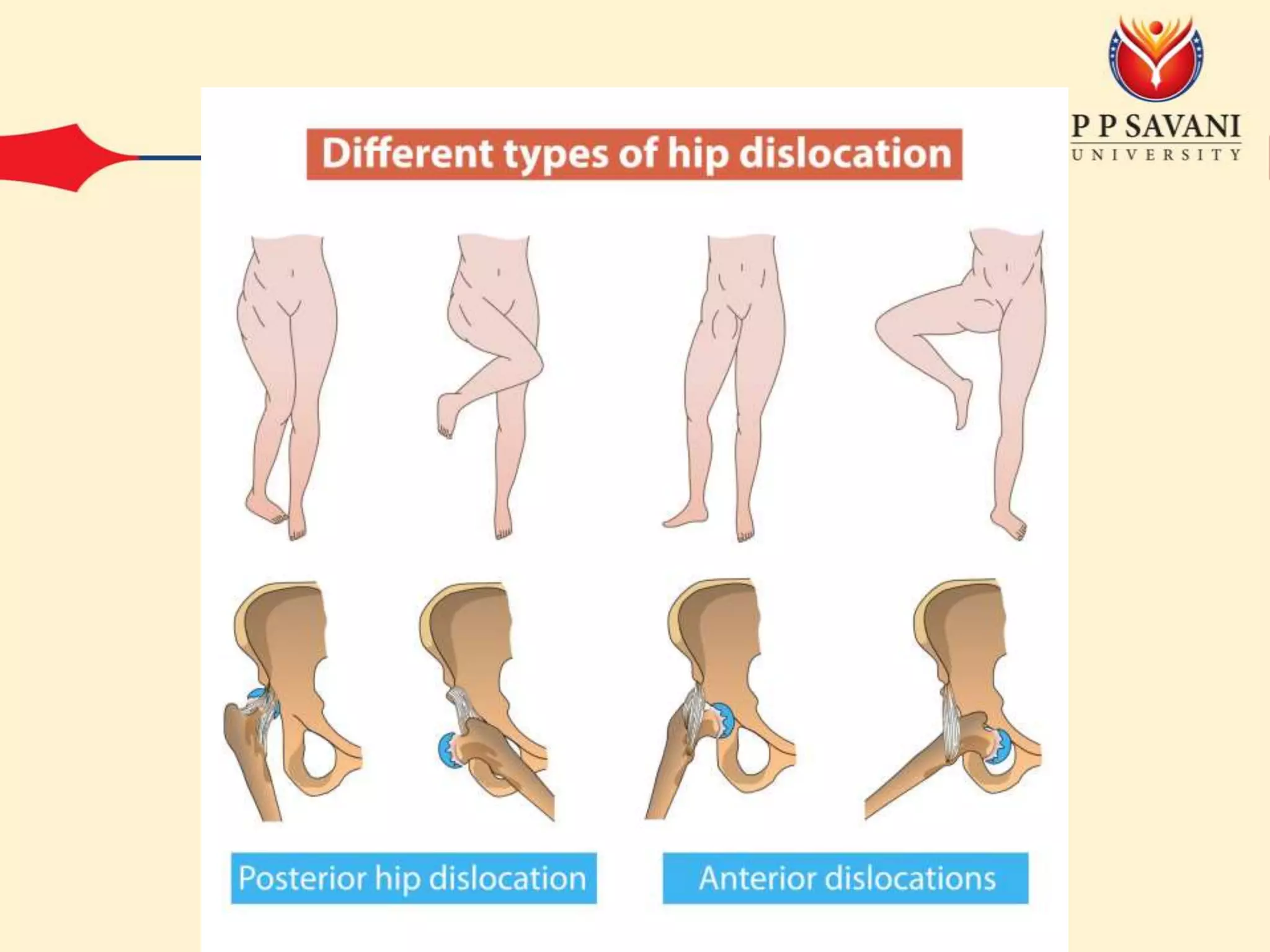 11. Hip dislocation | PPTX