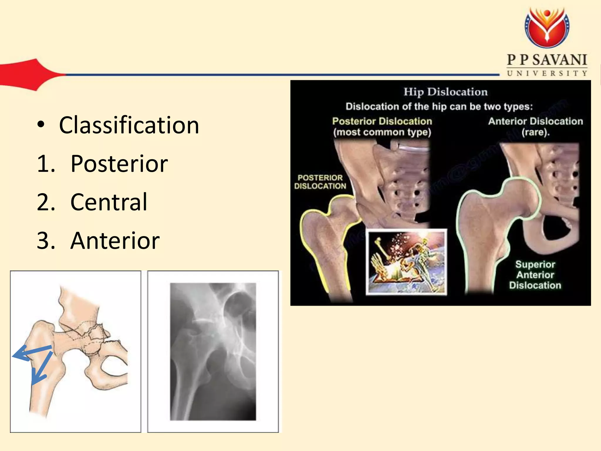 11. Hip dislocation | PPTX
