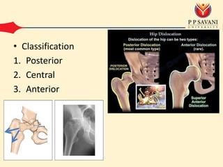 11. Hip dislocation | PPTX