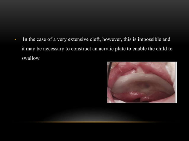 Cleft lip and palate rehabilitation - Dr Prathibha Prasad | PPTX | Pregnancy | Reproductive Health