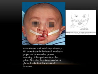 Cleft lip and palate rehabilitation - Dr Prathibha Prasad | PPTX