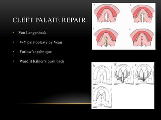 Cleft lip and palate rehabilitation - Dr Prathibha Prasad | PPTX